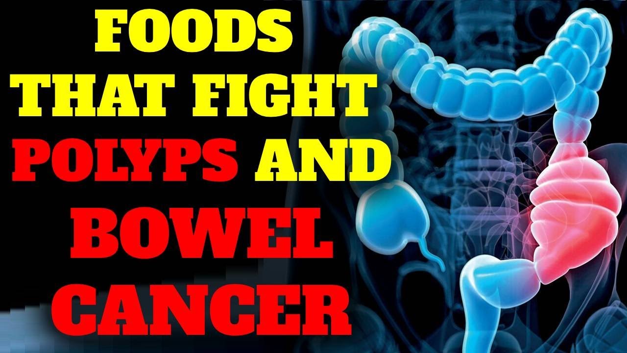 FOODS THAT FIGHT POLYPS AND BOWEL CANCER - Dining and Cooking
