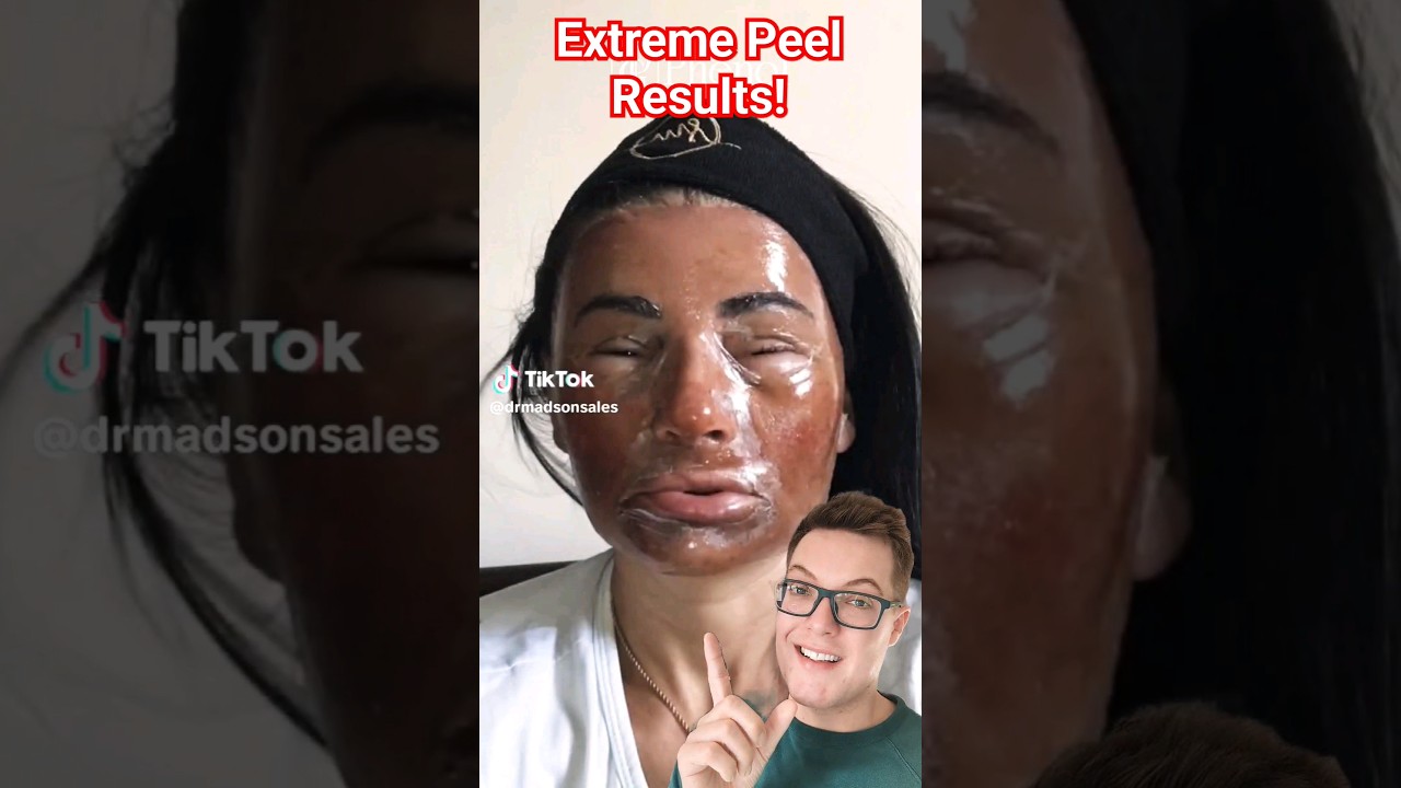 THIS IS CRAZY - Extreme Phenol Peel For Acne Scarring - Dining and Cooking